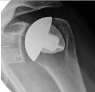 Shoulder Arthritis / Joint Replacement : Stemless humeral prosthesis ...