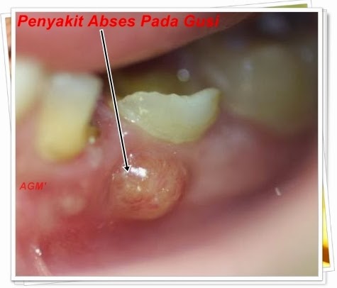Obat Abses Gusi