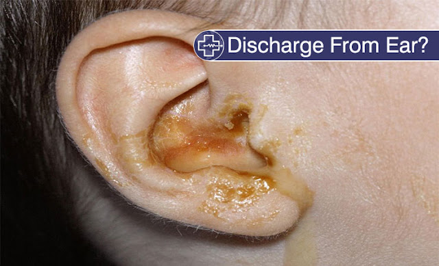 Discharge From Ear: Causes, Symptoms, Diagnosis, Home Remedies ...
