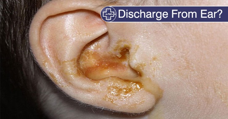 Discharge From Ear: Causes, Symptoms, Diagnosis, Home Remedies ...