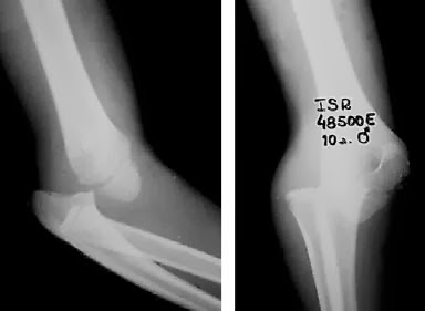 Figura 15. Luxación póstero-lateral de codo en un niñode 10 años