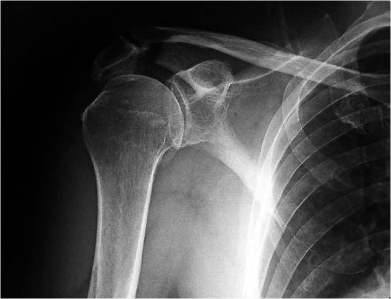 Imagenes Radiologicas: Radiografía AP Hombro