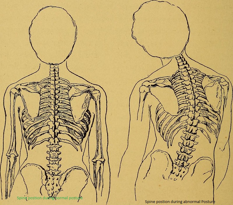 Kolkata Care: Understanding Autism | Symptom :Abnormal Body Posture ...