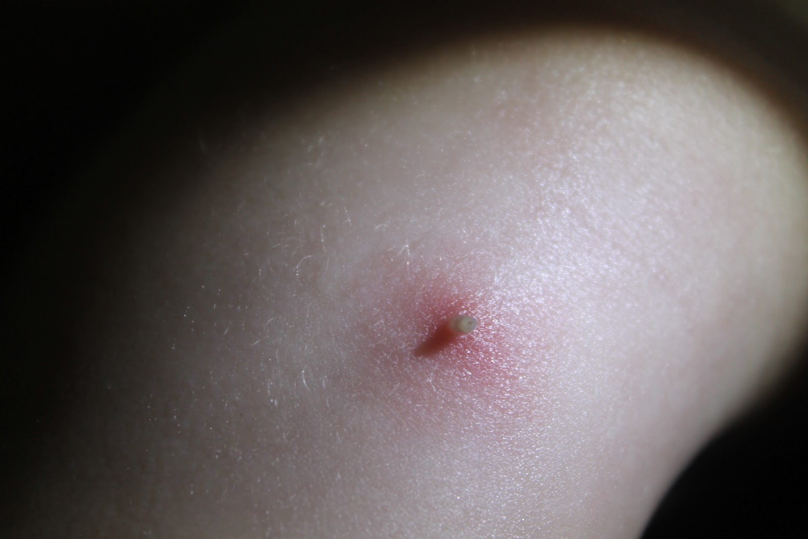 The Hutcheson Headline: Don't Let the Bed Bugs Bite!!