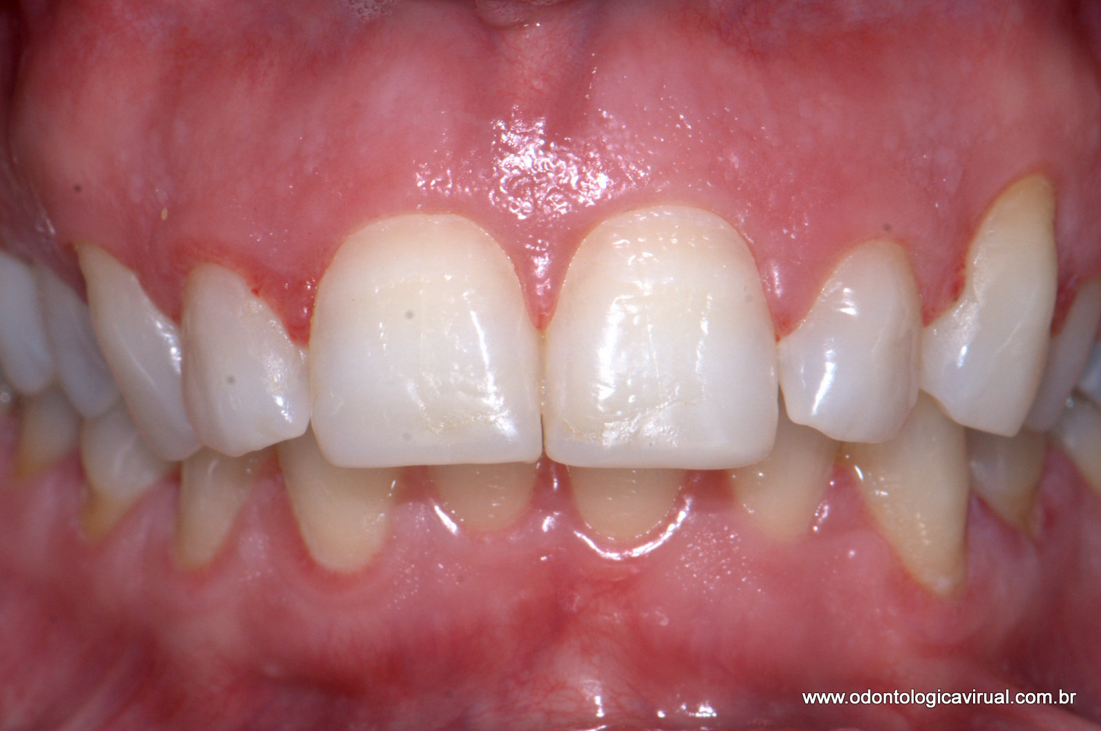 Inflamação Gengival encontrada