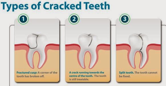 Omni Dental Group: Cracked Tooth Syndrome (CTS)