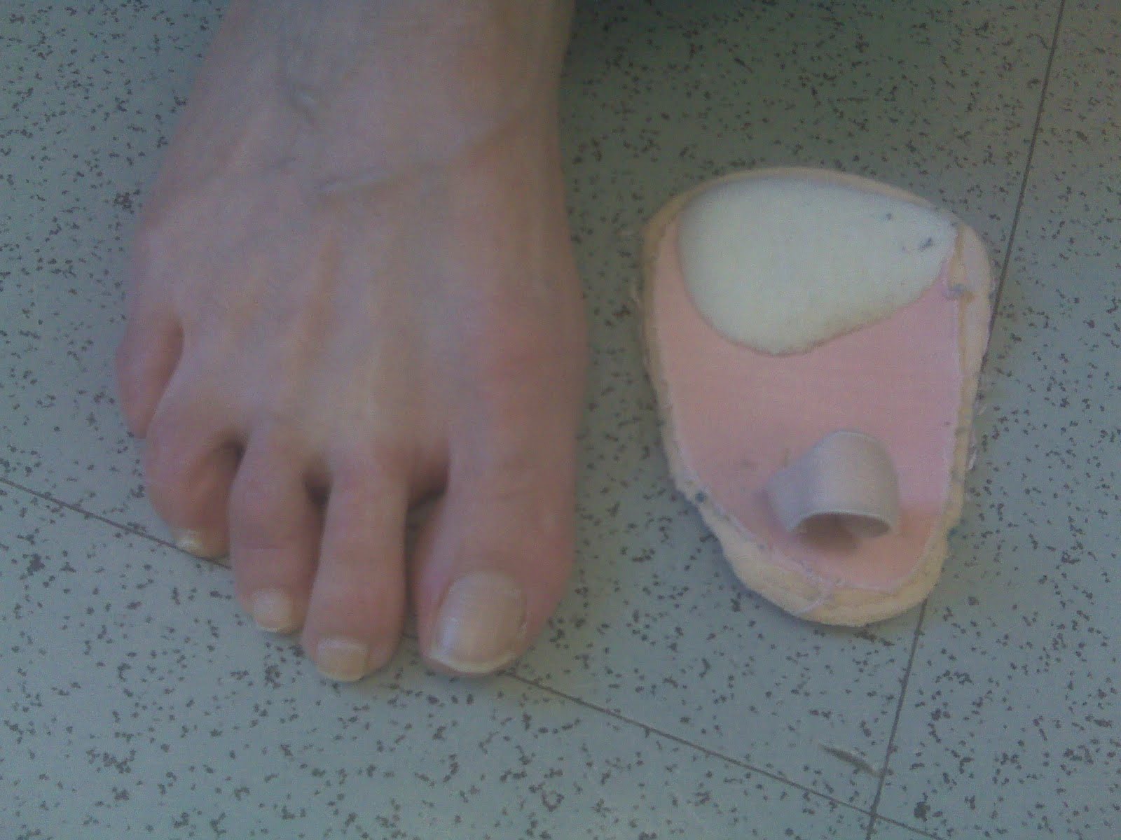 Foot and Ankle Problems By Dr. Richard Blake: 2nd Metatarsal Pain ...