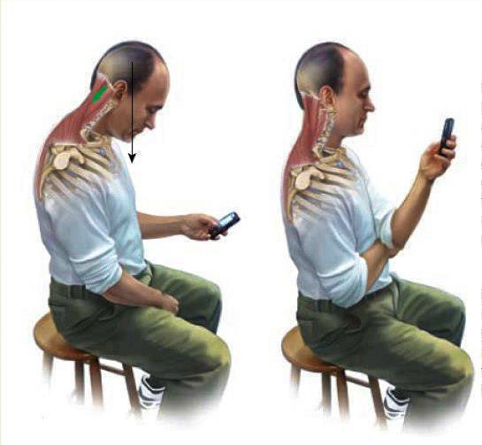 The Upper Cervical Blog: Forward Head Posture And Why It’s Serious