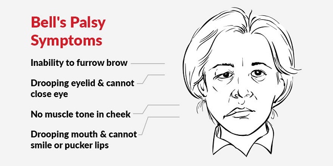 Bell's Palsy: Ketahui punca dan siapa yang berisiko tinggi - Jana Hazana