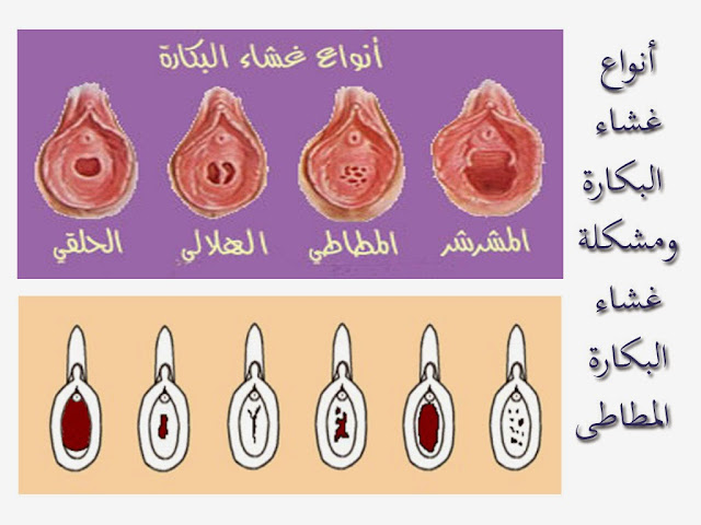 معلومات وتفاصيل عن فائدة غشاء البكارة وماذا بعد فض غشاء البكارة لمعلوماتك