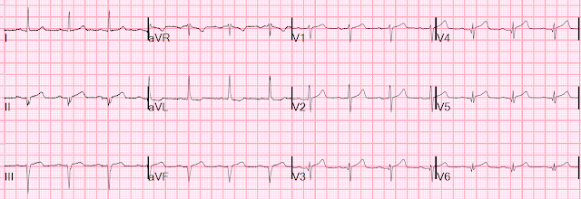 Dr. Smith's ECG Blog: Inferolateral STEMI: is there right ventricular ...