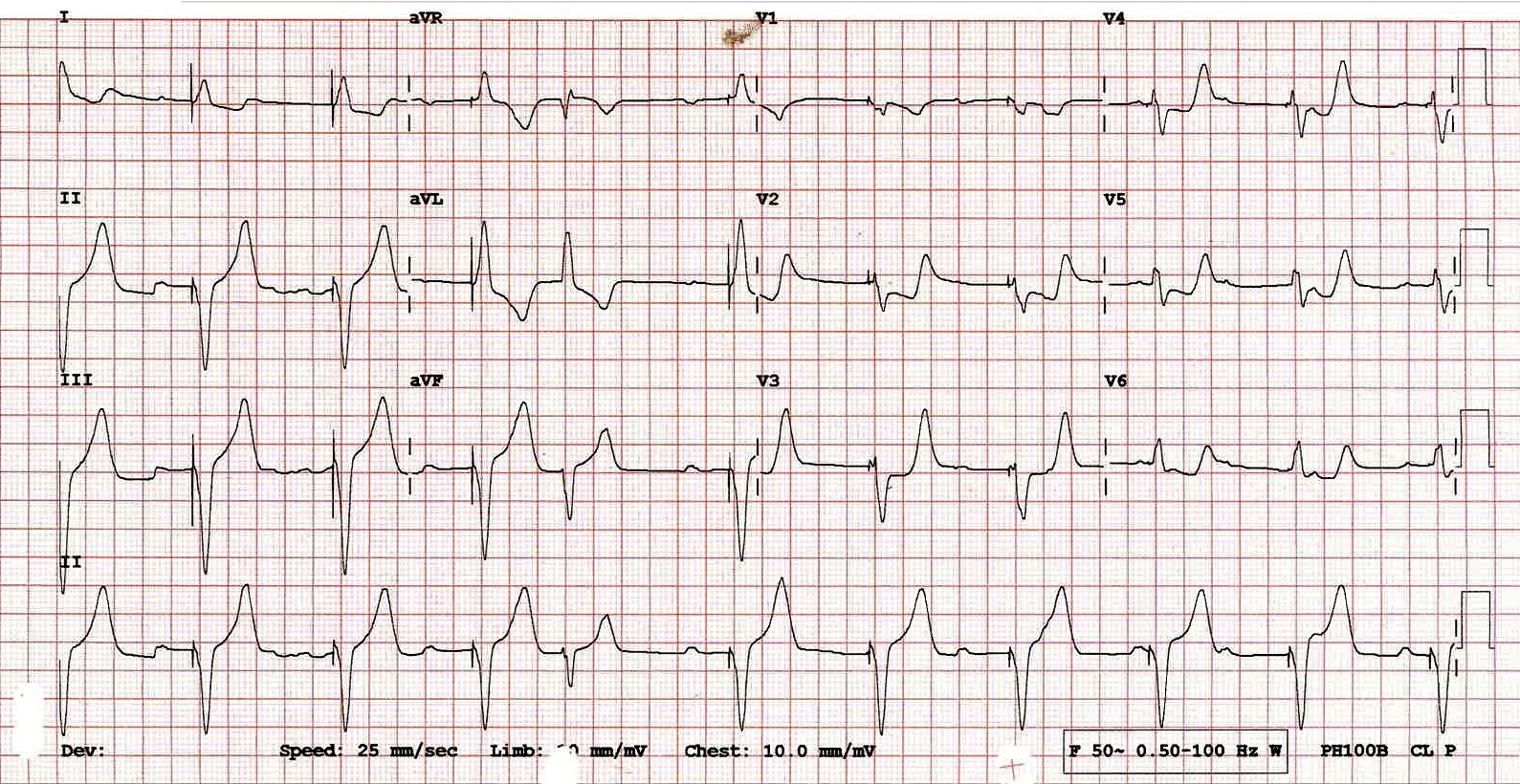 Sgarbossa Criteria Untuk Diagnosis AMI pada LBBB | INA - ECG