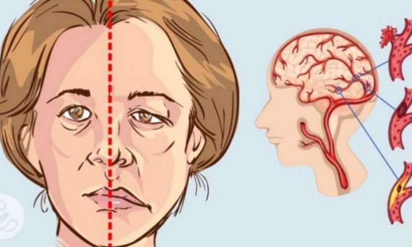obat stroke terampuh untuk keluarga yg kena stroke