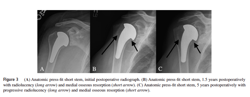 Shoulder Arthritis / Rotator Cuff Tears / Shoulder Pain : Short humeral ...