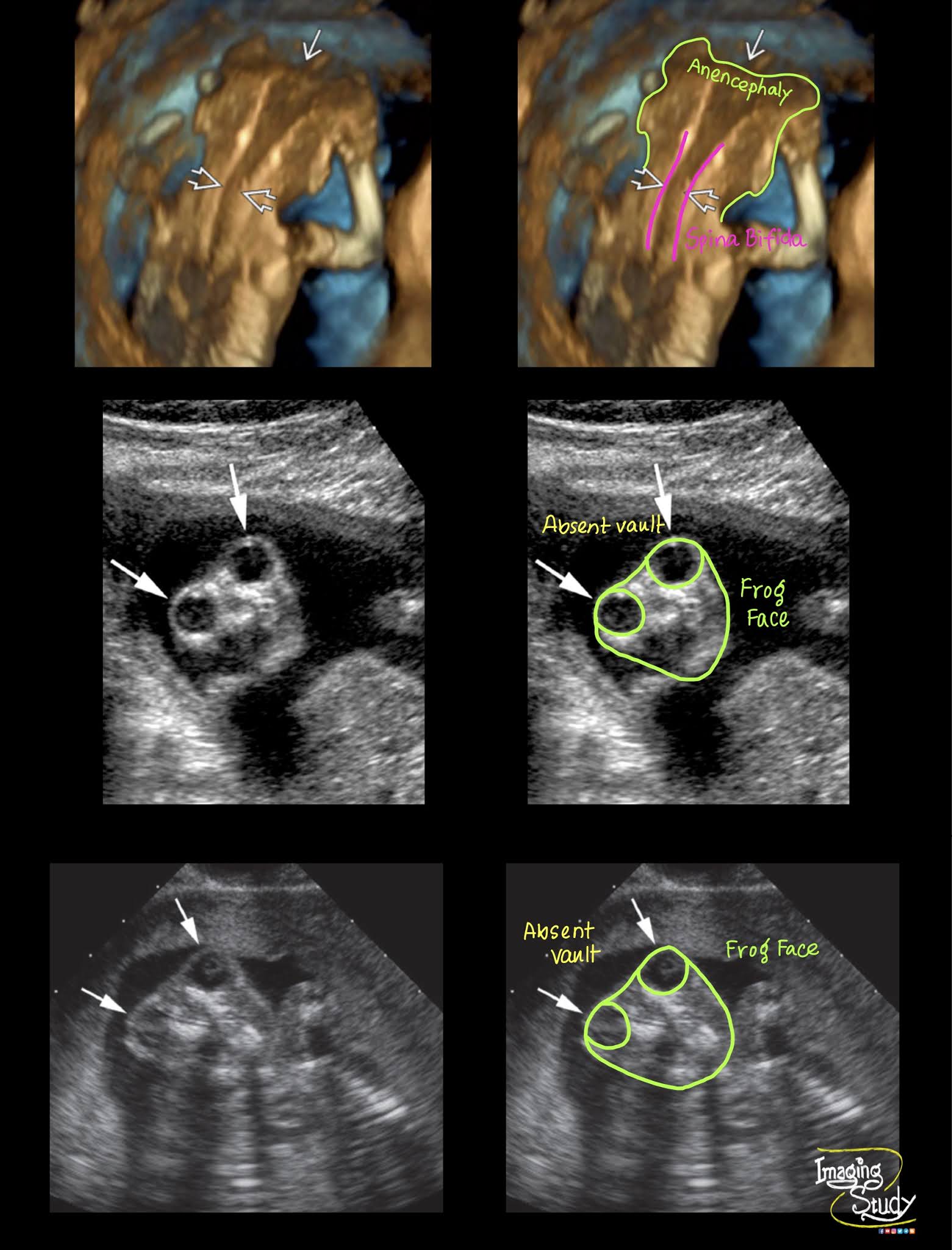 Exencephaly - Anencephaly ~ Imaging Study