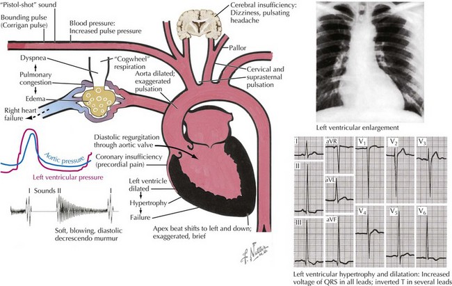 REGURGITASI AORTA - Panduan Praktik Klinis Jantung dan Pembuluh Darah