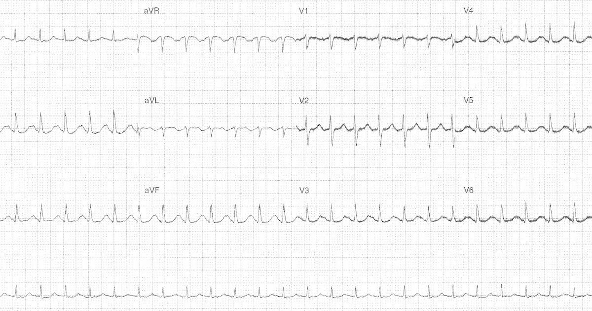 ECG of the Week: ECG of the Week - 8th October 2018 - Interpretation