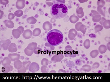 Lab Atlas: Prolymphocyte