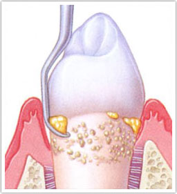 Save Your Teeth & be Smile :): Teknik Scaling