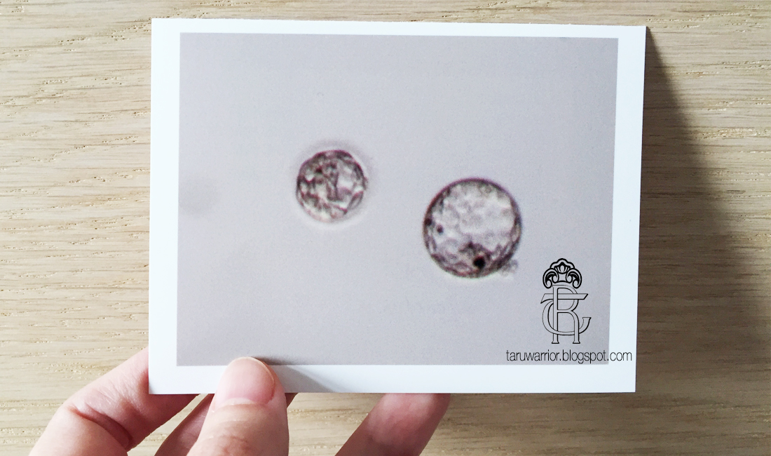 IVF Blog by Taru: Fresh Embryo Transfer: Day 5 Blastocyst