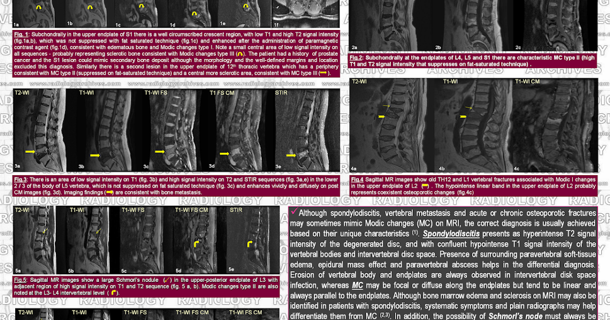 Radiology Archives: Dilemmas in MRI Assessment of Modic Changes
