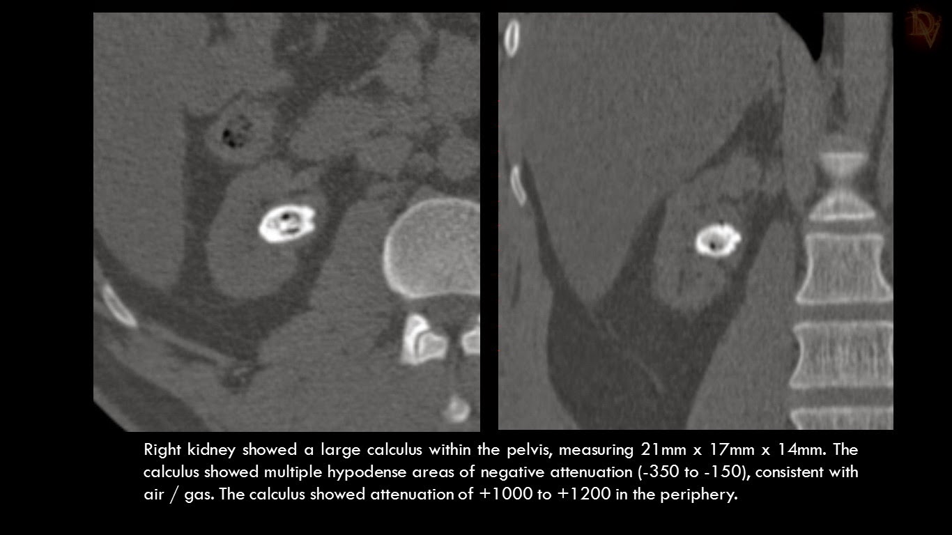 Ultimate Radiology : RARE : Gas containing renal calculus