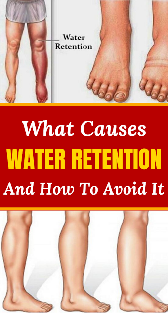 What Causes Water Retention And How To Avoid It | Holistic And Healthy