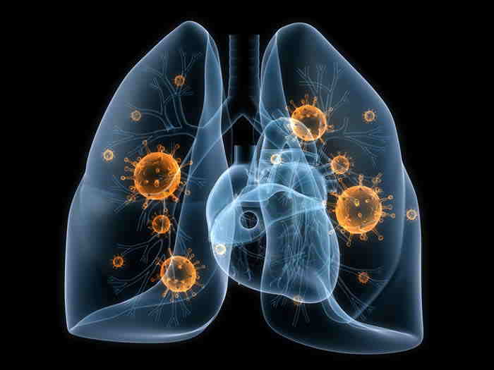 Lung Cancer: Lung Cancer Causes – Genetics