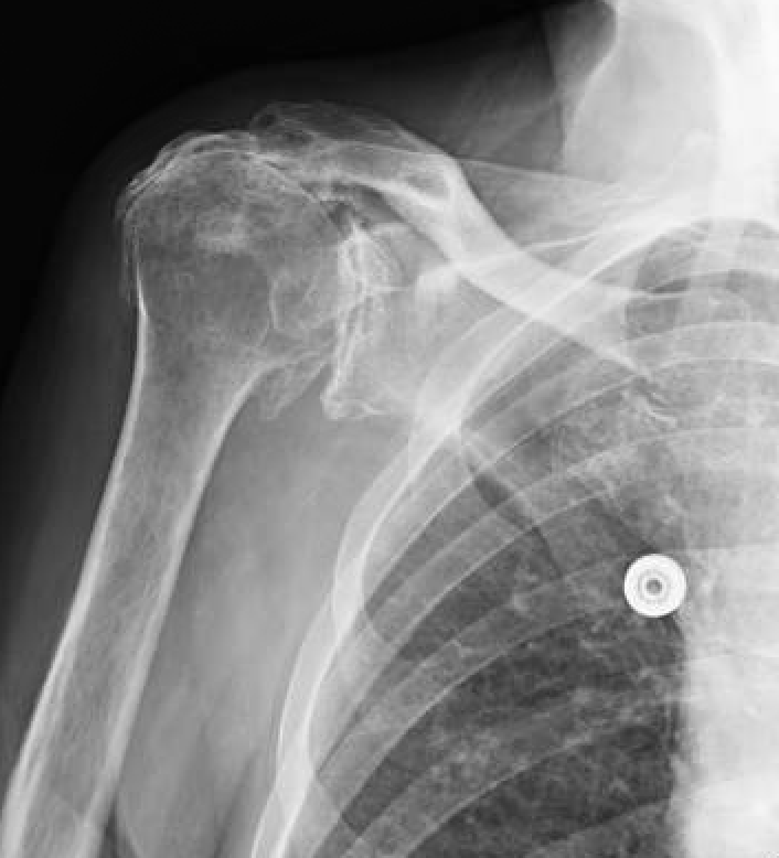 Shoulder and Elbow Surgery: Dislocation of reverse shoulder replacement ...