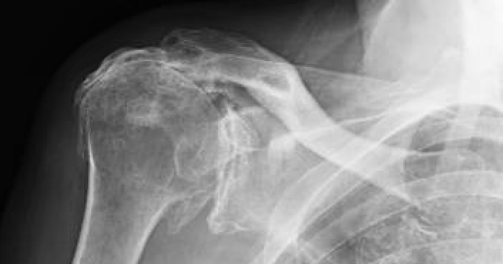 Shoulder and Elbow Surgery: Dislocation of reverse shoulder replacement ...