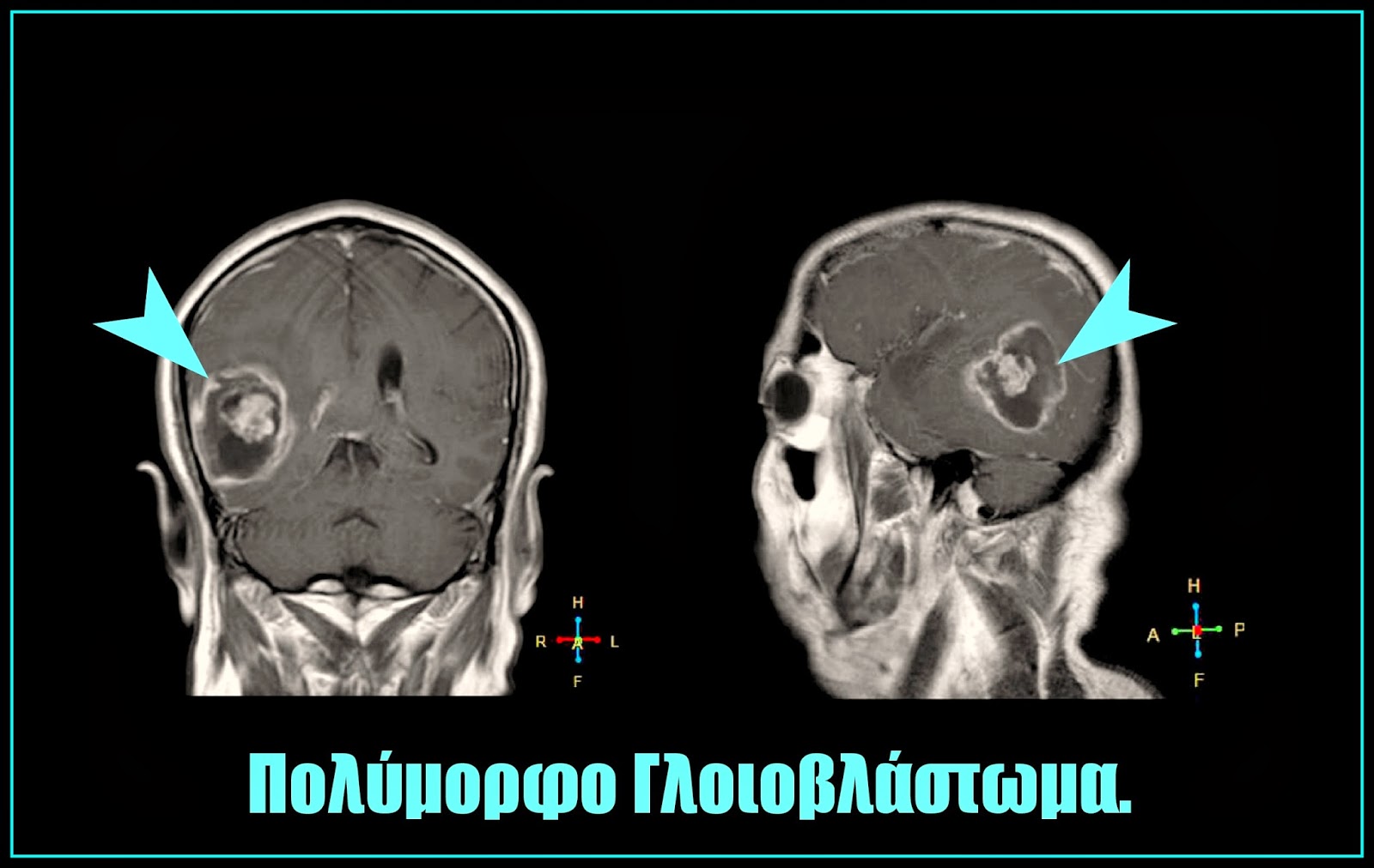 Κωνσταντίνος Χ. Δαβανέλος: Πολύμορφο Γλοιοβλάστωμα Εγκεφάλου.