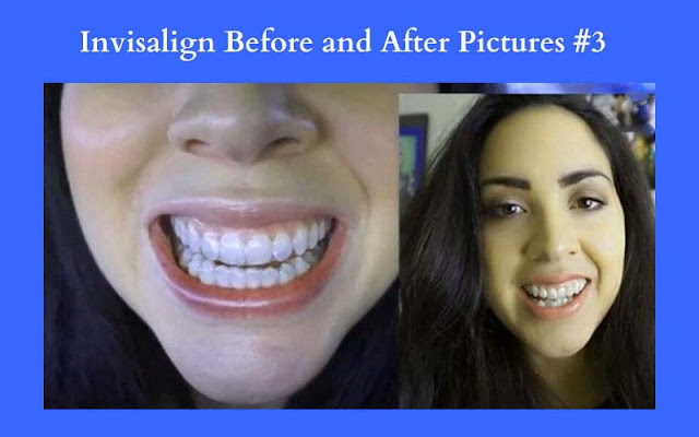 Invisalign Before And After Pictures and Personal Review