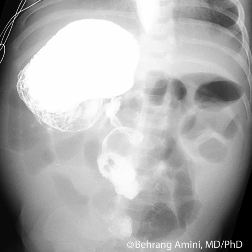 Roentgen Ray Reader: Corkscrews in Radiology