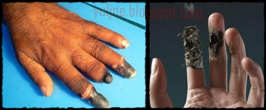 BUERGER DISEASE (Obliterans Thromboangiitis) | 4prohealth