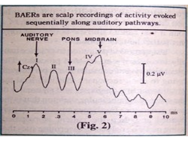 Audiology ~ Notes on NEET PG