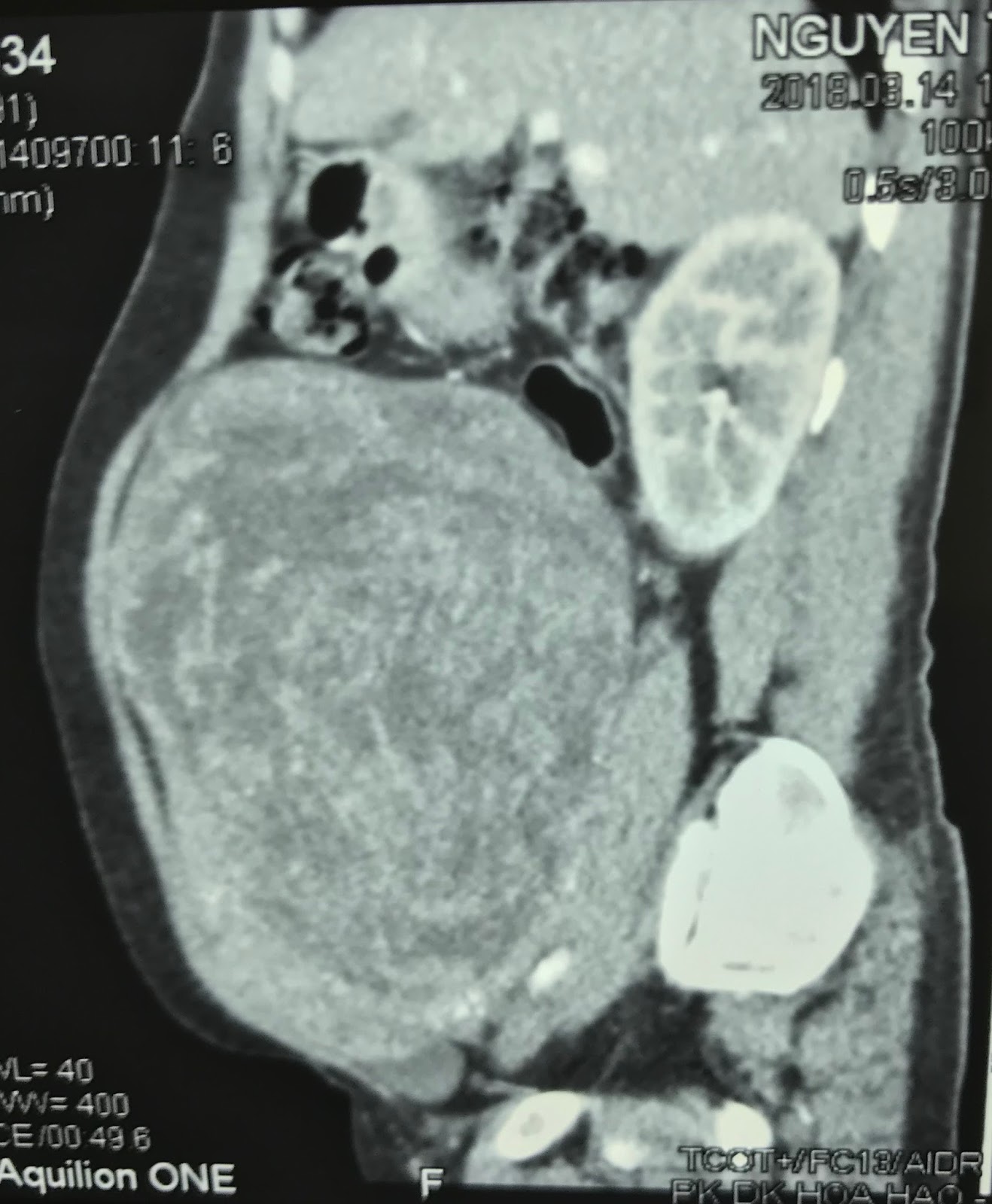 VIETNAMESE MEDIC ULTRASOUND: CASE 483: UTERINE GIANT MYOMA, Dr PHAN ...