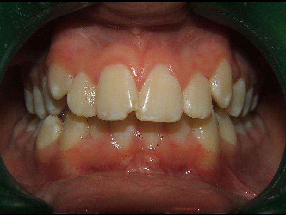 Dr. Miguel Angel Marroquin: EXTRACCION DE PREMOLARES SUPERIORES EN ...