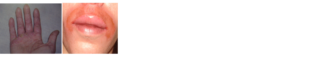 Guia Prático de Feridas : FERIDAS TRAUMÁTICAS