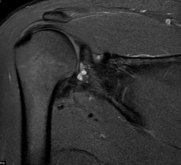 Glenoid Subchondral Cystic Lesion -Approach. - Sumer's Radiology Blog
