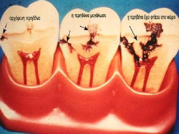 e-dentistry: Θεραπεία των κοιλοτήτων στο δόντι