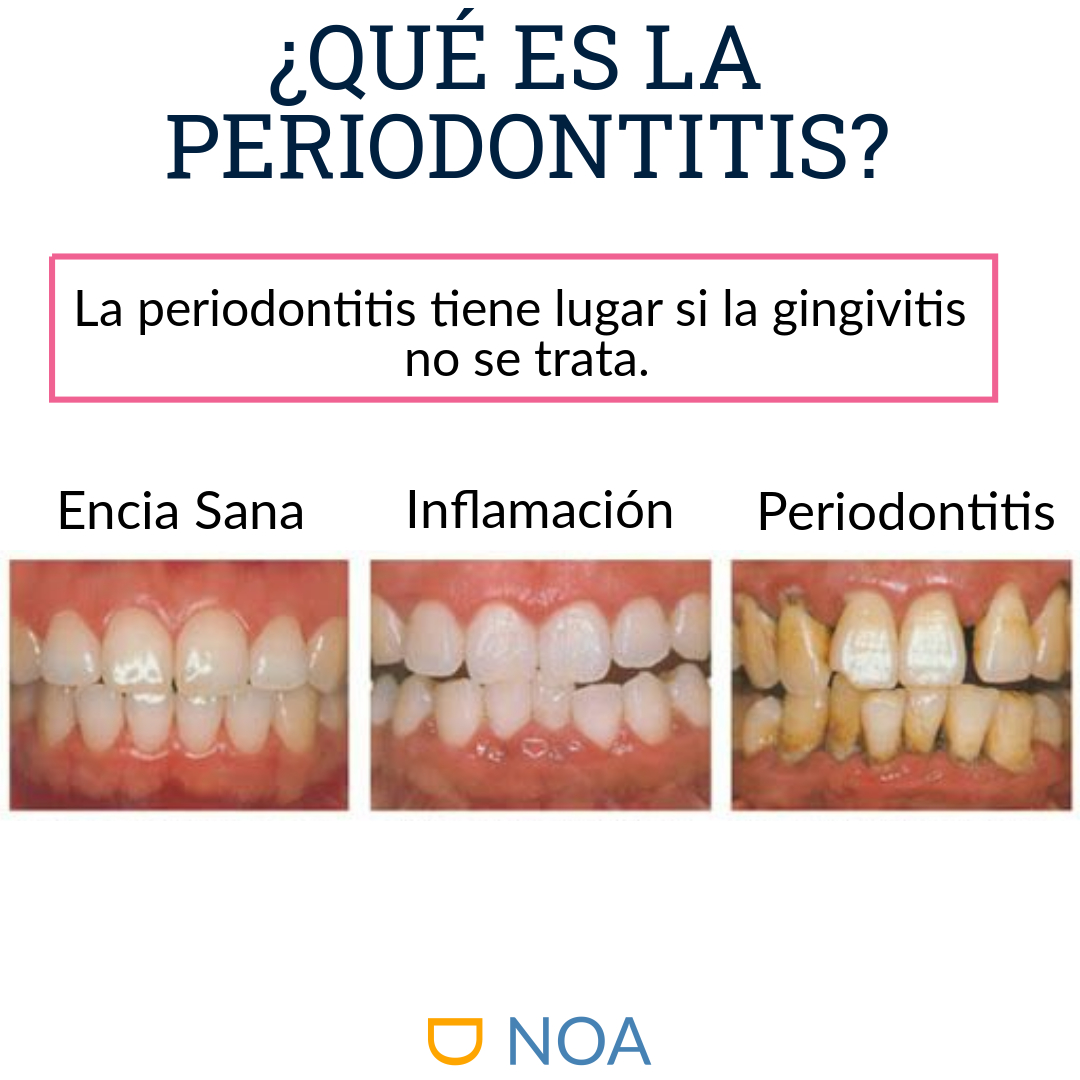 ¿QUE ES LA PERIODONTITIS?
