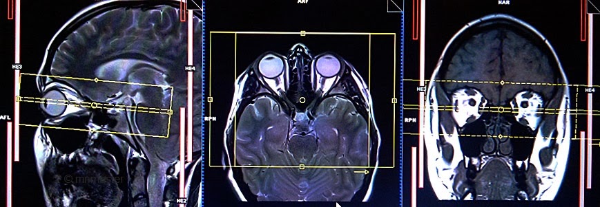 MRI Protocols: ORBIT MRI PLANNING REFERRAL LINES , MRI ORBIT TECHNIQUES