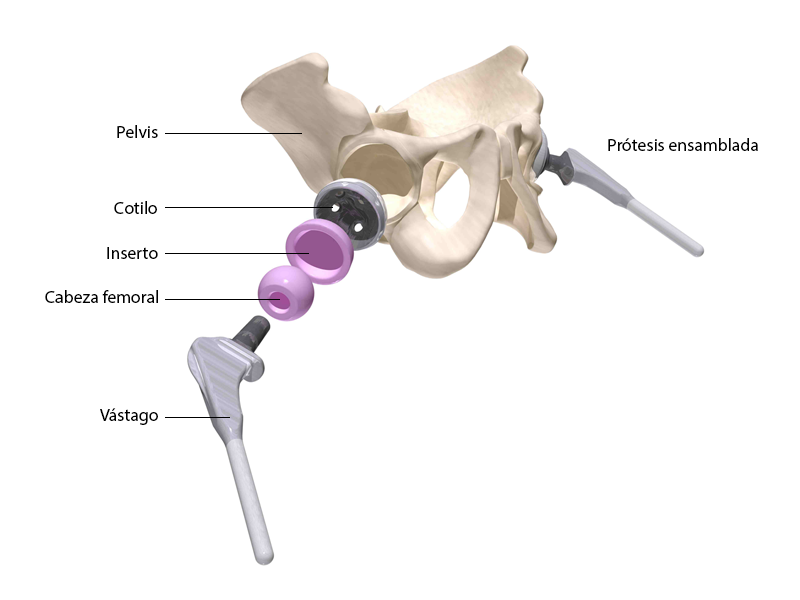 ENFERMERÍA EN TRAUMATOLOGÍA Y ORTOPEDIA: PRÓTESIS DE CADERA