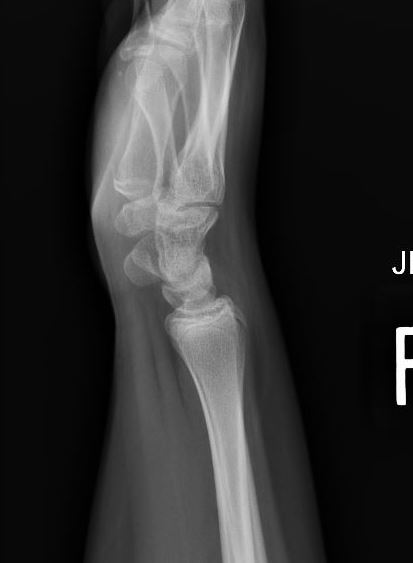 Early Action in Madelungs Deformity | Congenital Hand and Arm ...