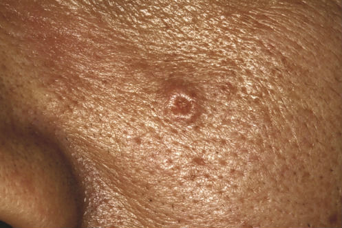 Skin Care Tips: Sebaceous Hyperplasia: Causes and Treatments