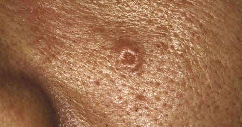 Skin Care Tips: Sebaceous Hyperplasia: Causes and Treatments