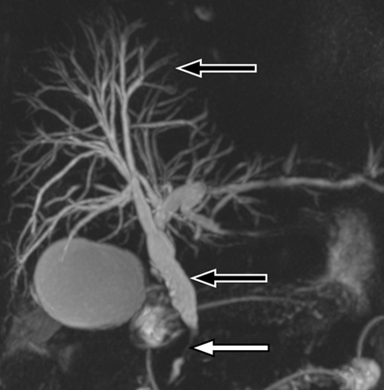 Abdominal Section: MRCP