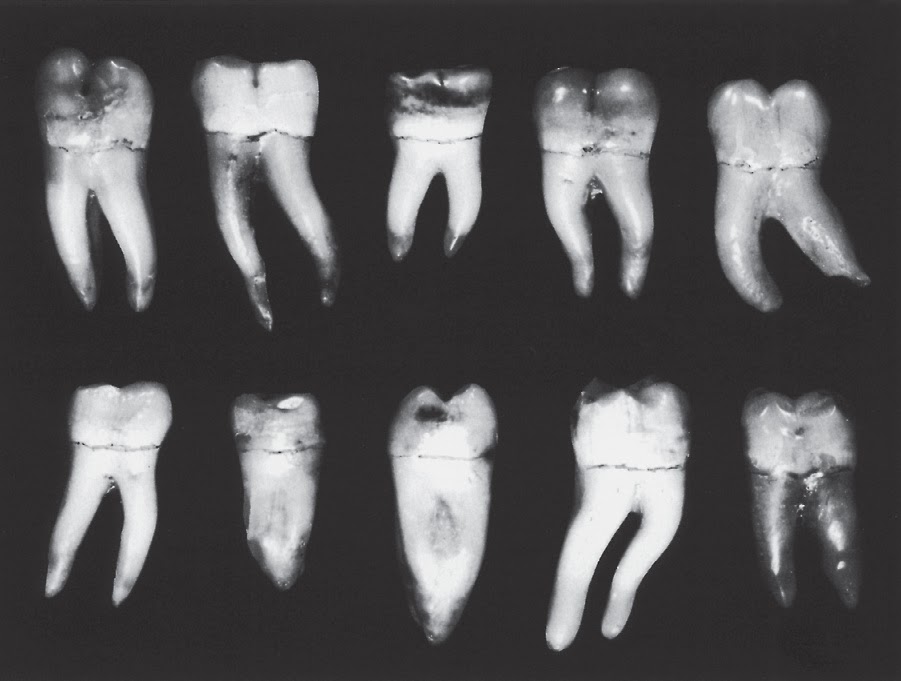 Dentosphere : World of Dentistry: Mandibular Second Molar - Curved root ...