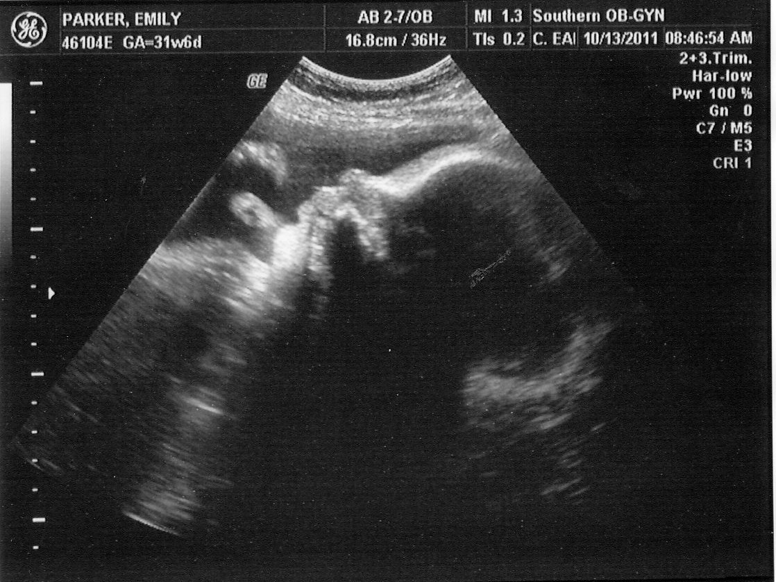 32 Weeks Ultrasound