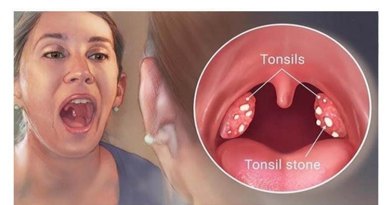 4 Effective Ways To Remove Tonsil Stones Without Surgery - healhty and tips